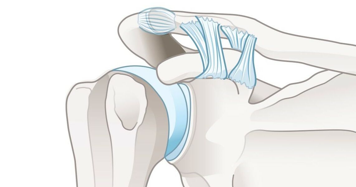 Icd 10 Ac Gelenk | ICD-10-GM-2025: gelenks arthrose – DNAGIX